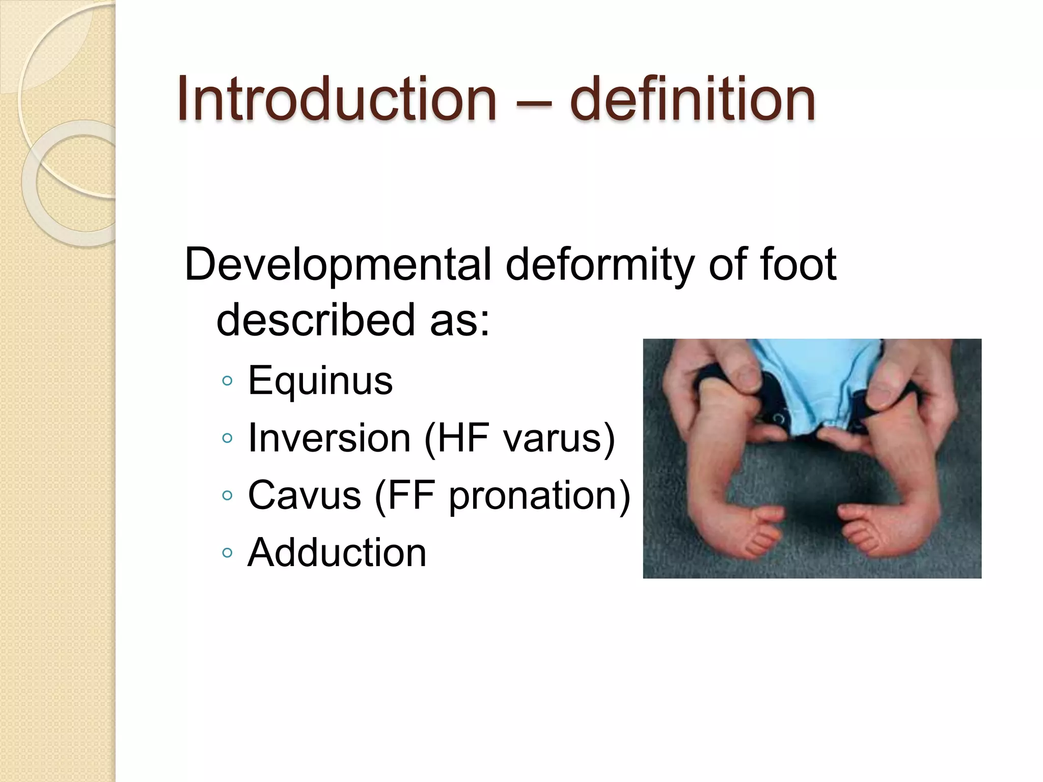 Congenital clubfoot | PPTX
