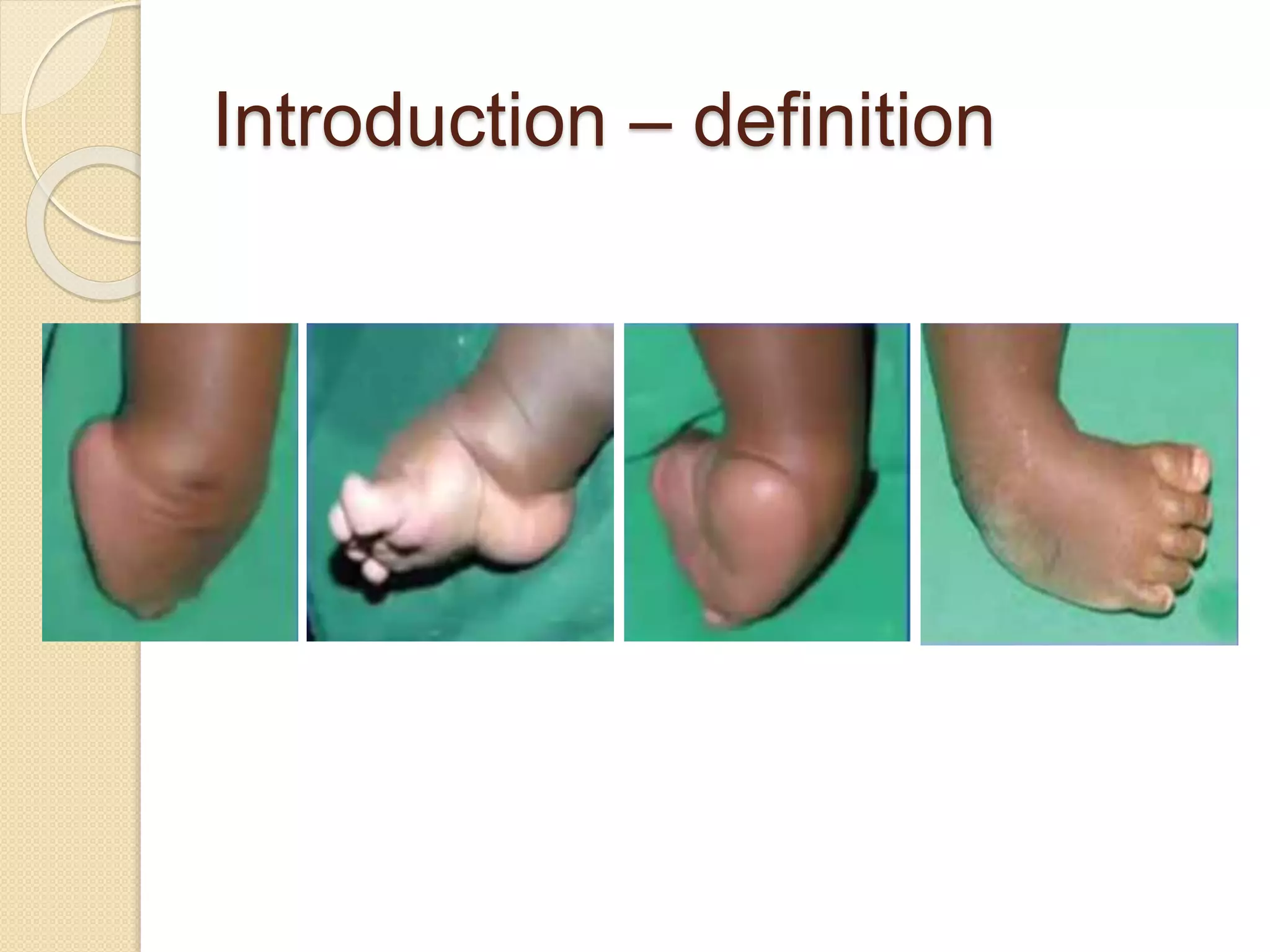 Congenital clubfoot | PPTX
