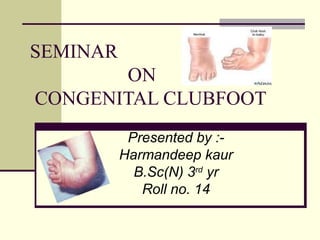 a brief explaination about congenital club foot.ppt