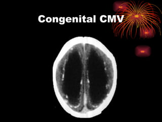 Congenital cmv infection | PPT