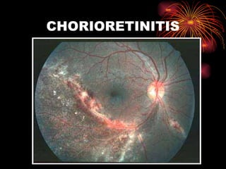 Chorioretinitis Cmv