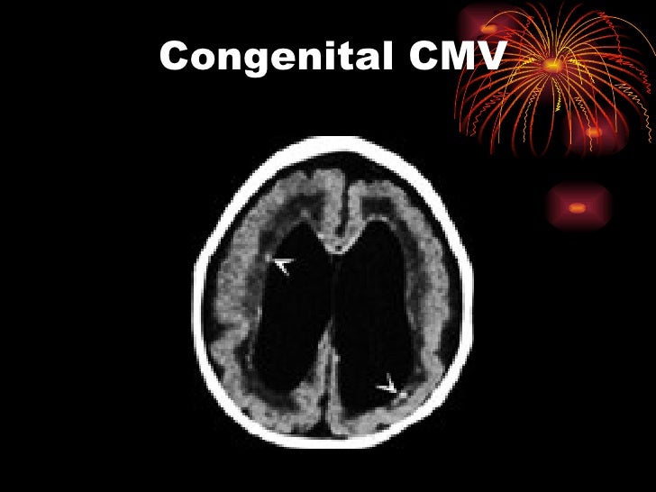 Congenital cmv infection