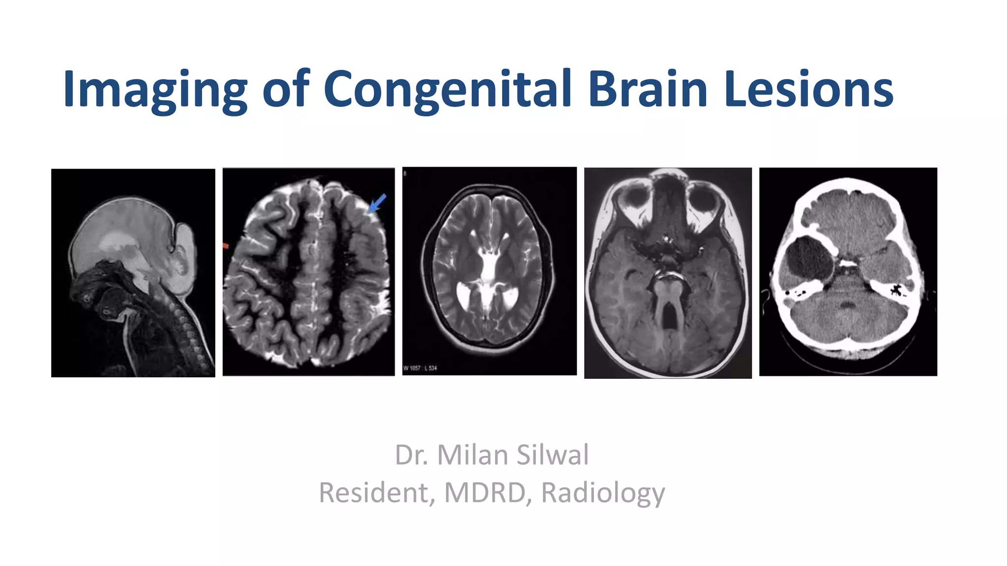 Congenital CNS lesions | PPTX