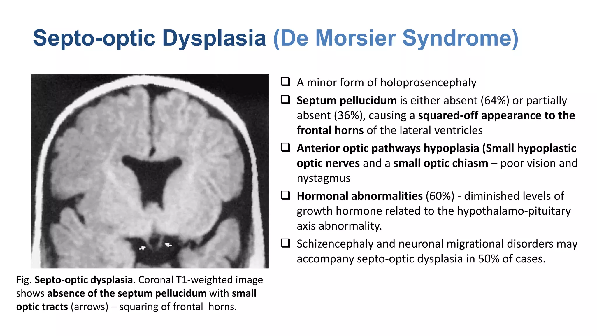 Congenital CNS lesions | PPTX
