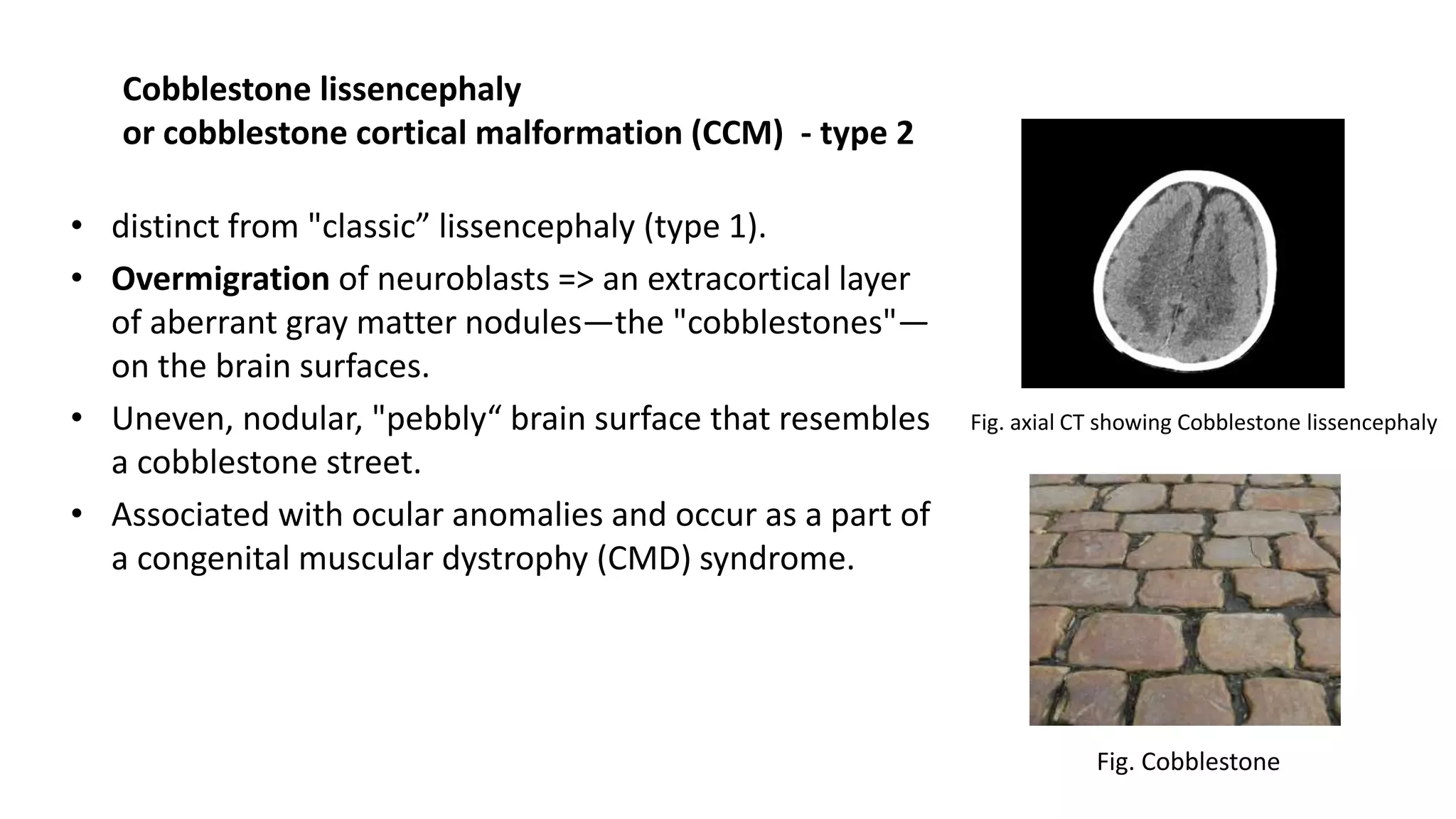 Congenital CNS lesions | PPTX