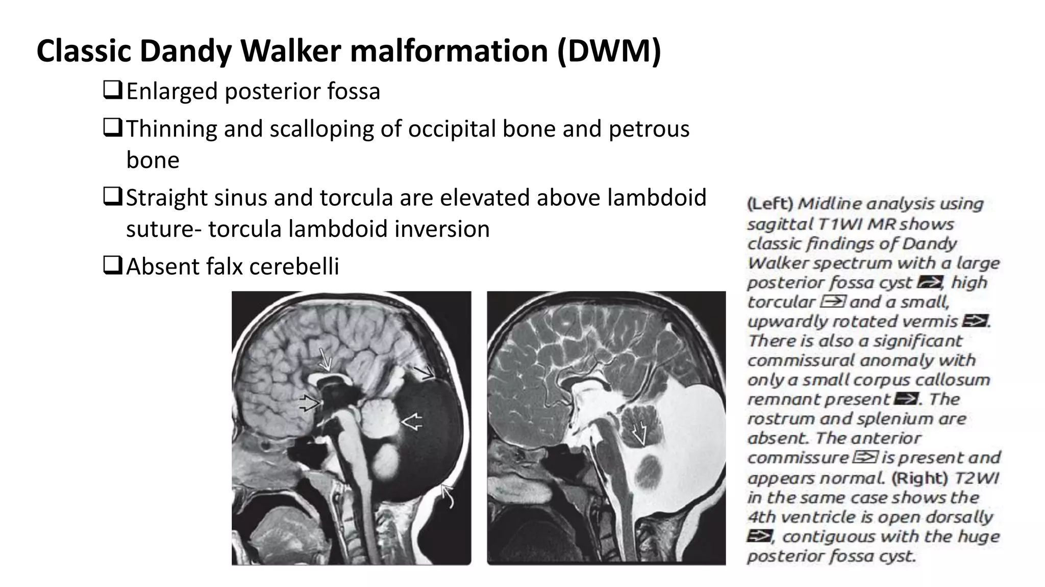 Congenital CNS lesions | PPTX