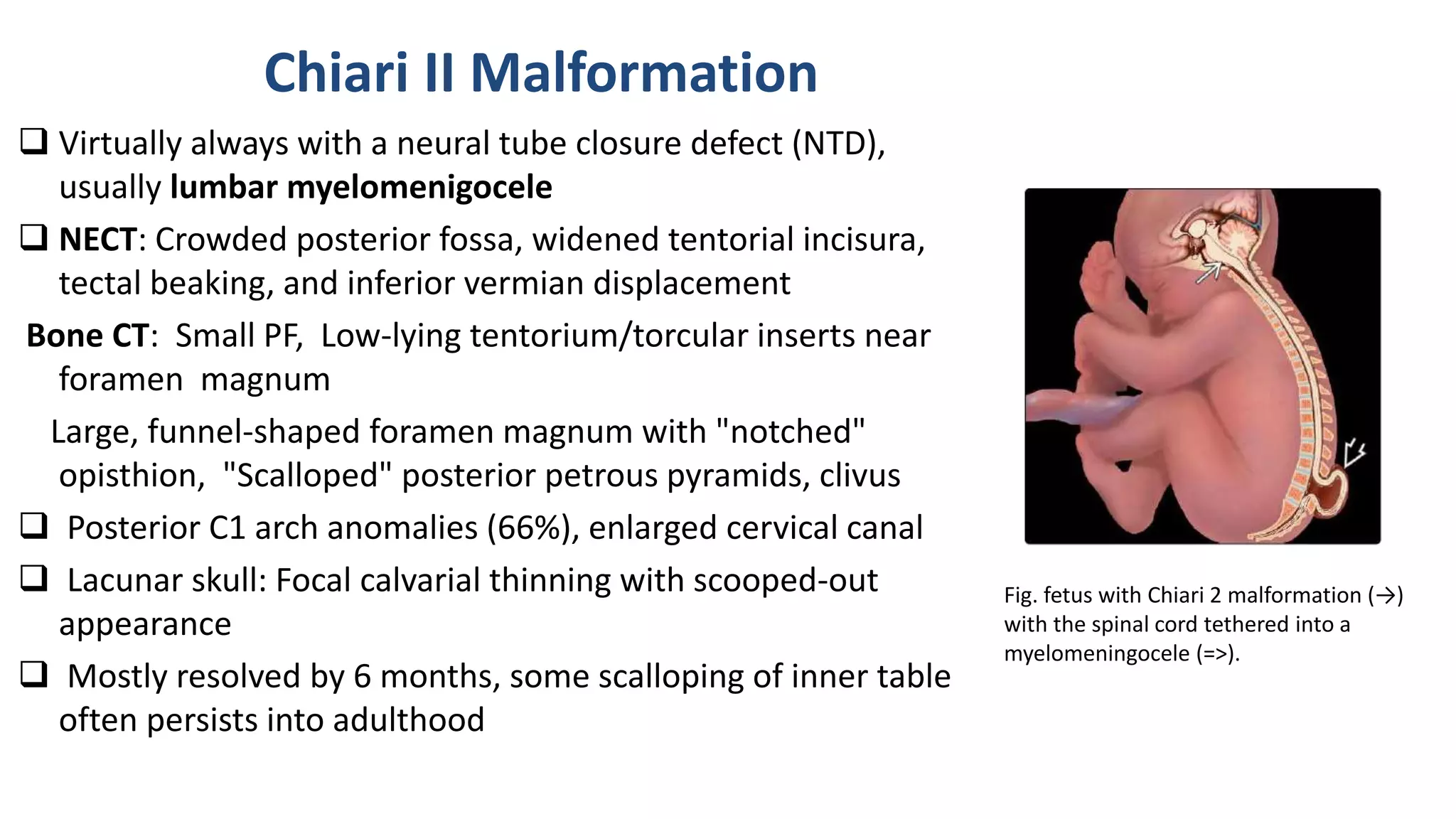 Congenital CNS lesions | PPTX