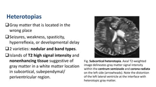Congenital CNS lesions | PPTX