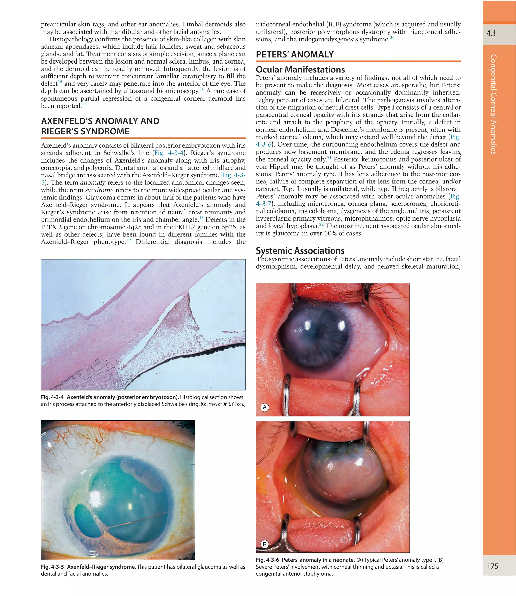 Congenital corneal anomalies | PDF