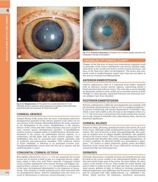 Congenital corneal anomalies | PDF
