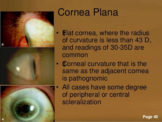 Congenital corneal disorders