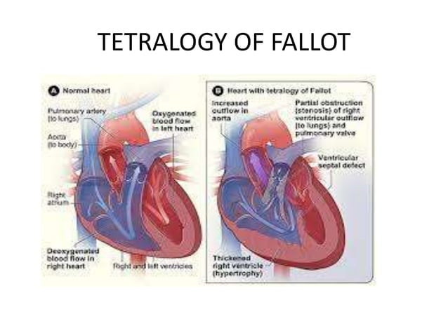 CONGENITAL CYANOTIC HEART DISEASES I - ABSUTH.pptx