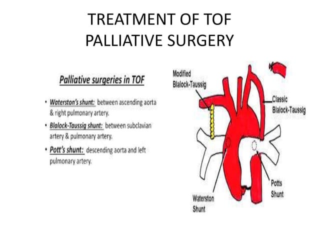 CONGENITAL CYANOTIC HEART DISEASES I - ABSUTH.pptx