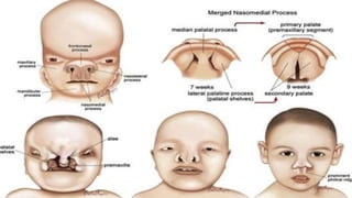 Congenital Defects in Children.pptx