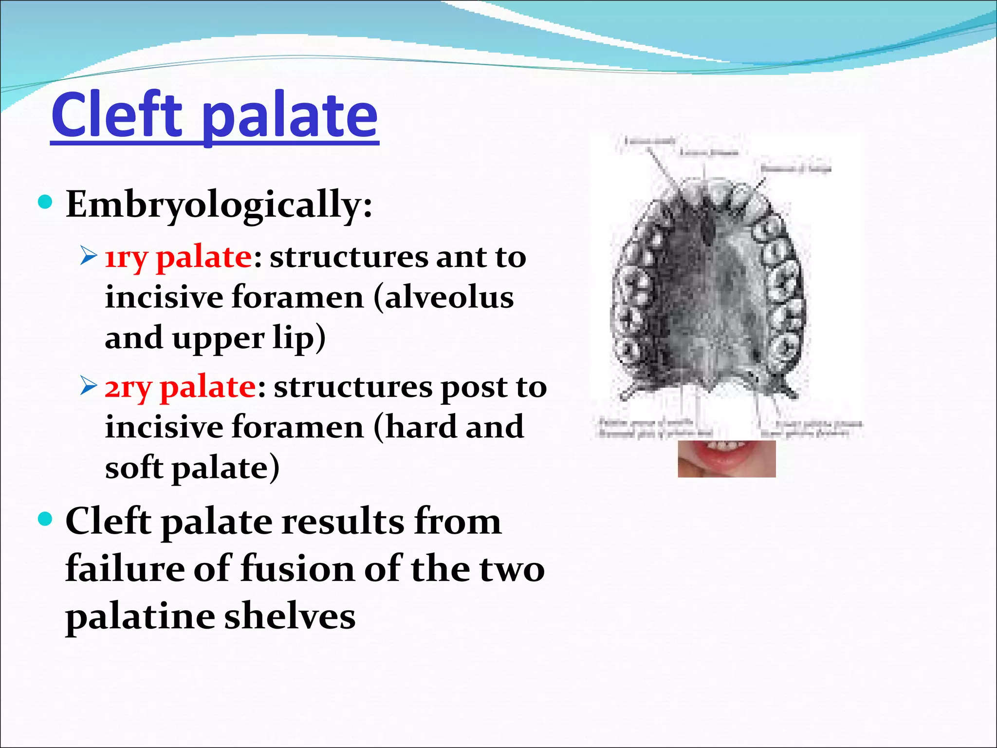 Congenital defects of the Face | PPT