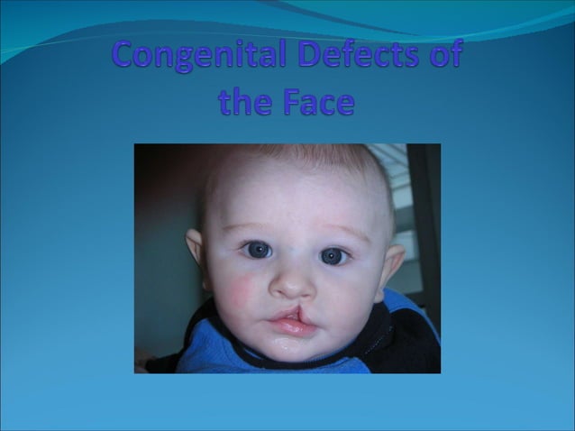 Congenital defects of the Face | PPT | Ear, Nose and Throat Conditions ...