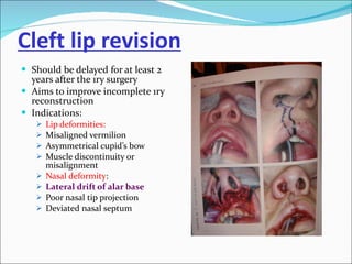 Congenital defects of the Face | PPT