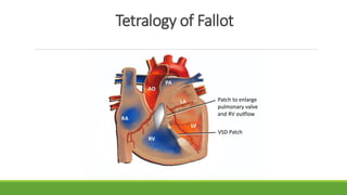 congenital defects of the heart in adults.pdf