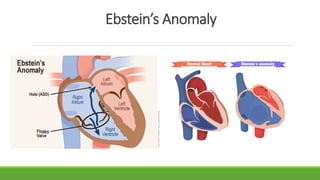 congenital defects of the heart in adults.pdf