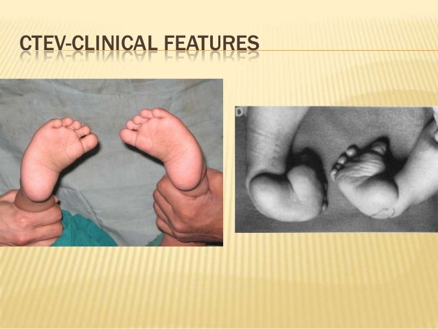 Congenital Deformities