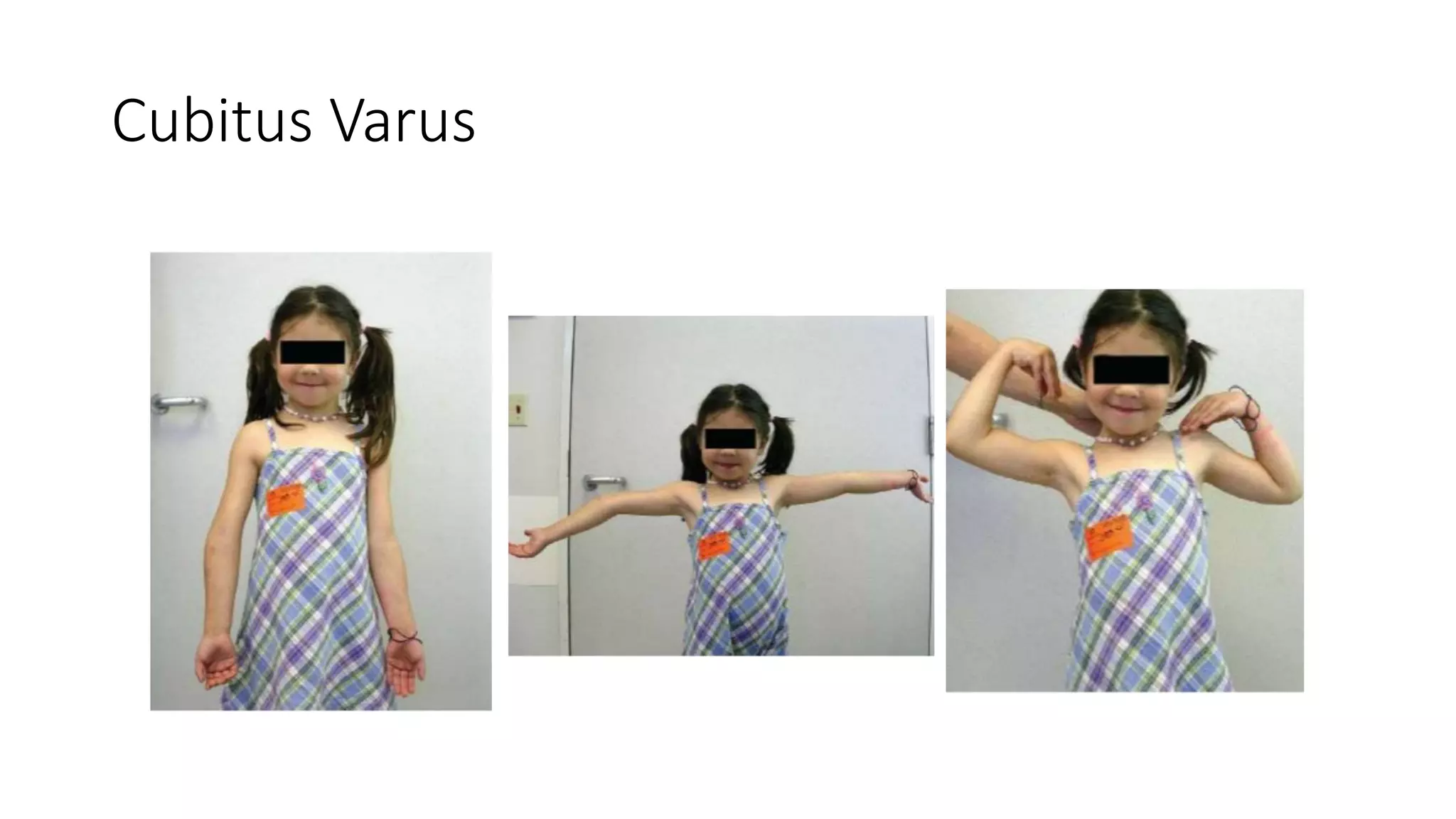 Congenital and Acquired Deformities around Elbow.pptx