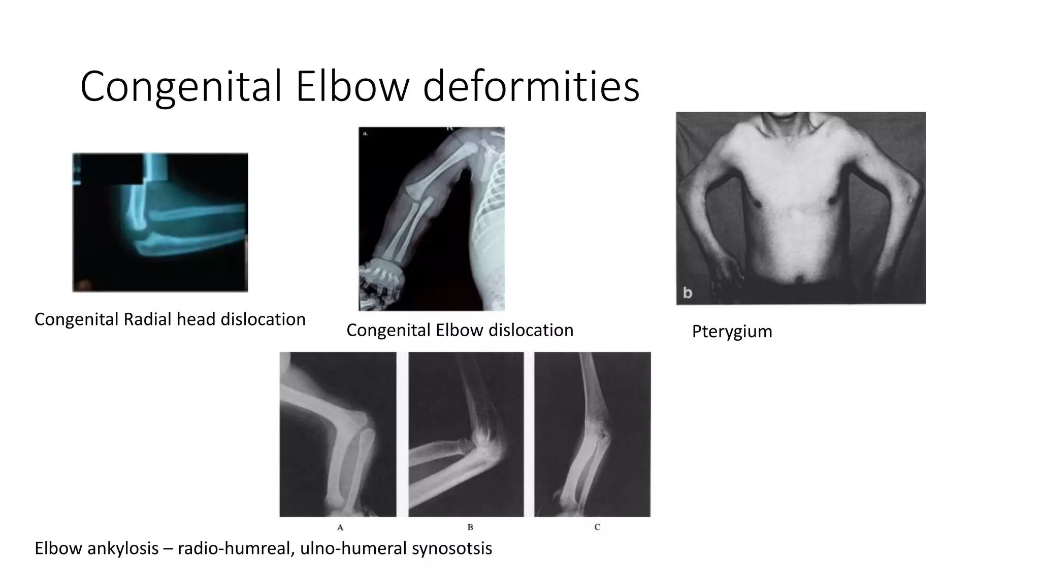 Congenital and Acquired Deformities around Elbow.pptx