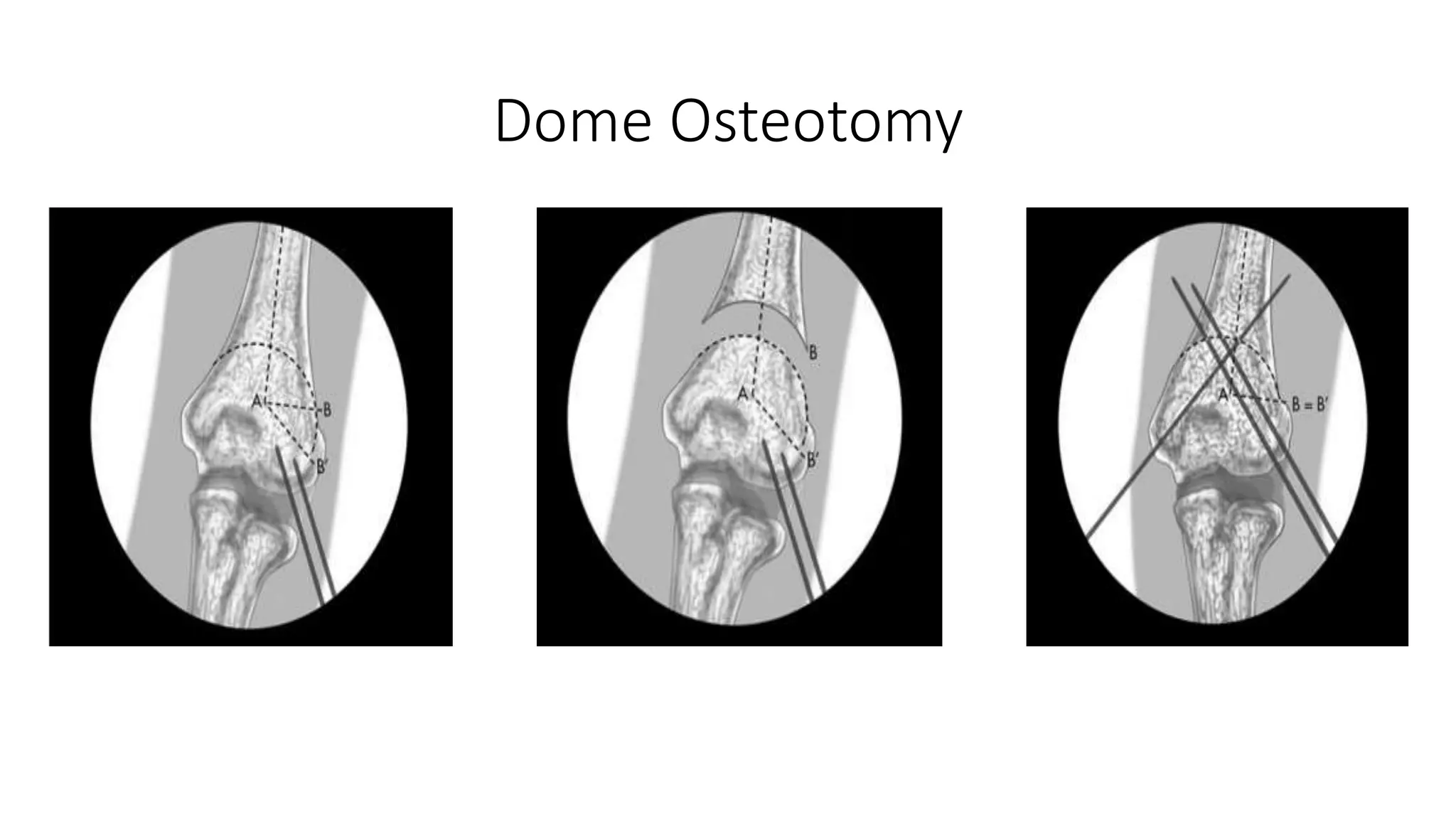 Congenital and Acquired Deformities around Elbow.pptx