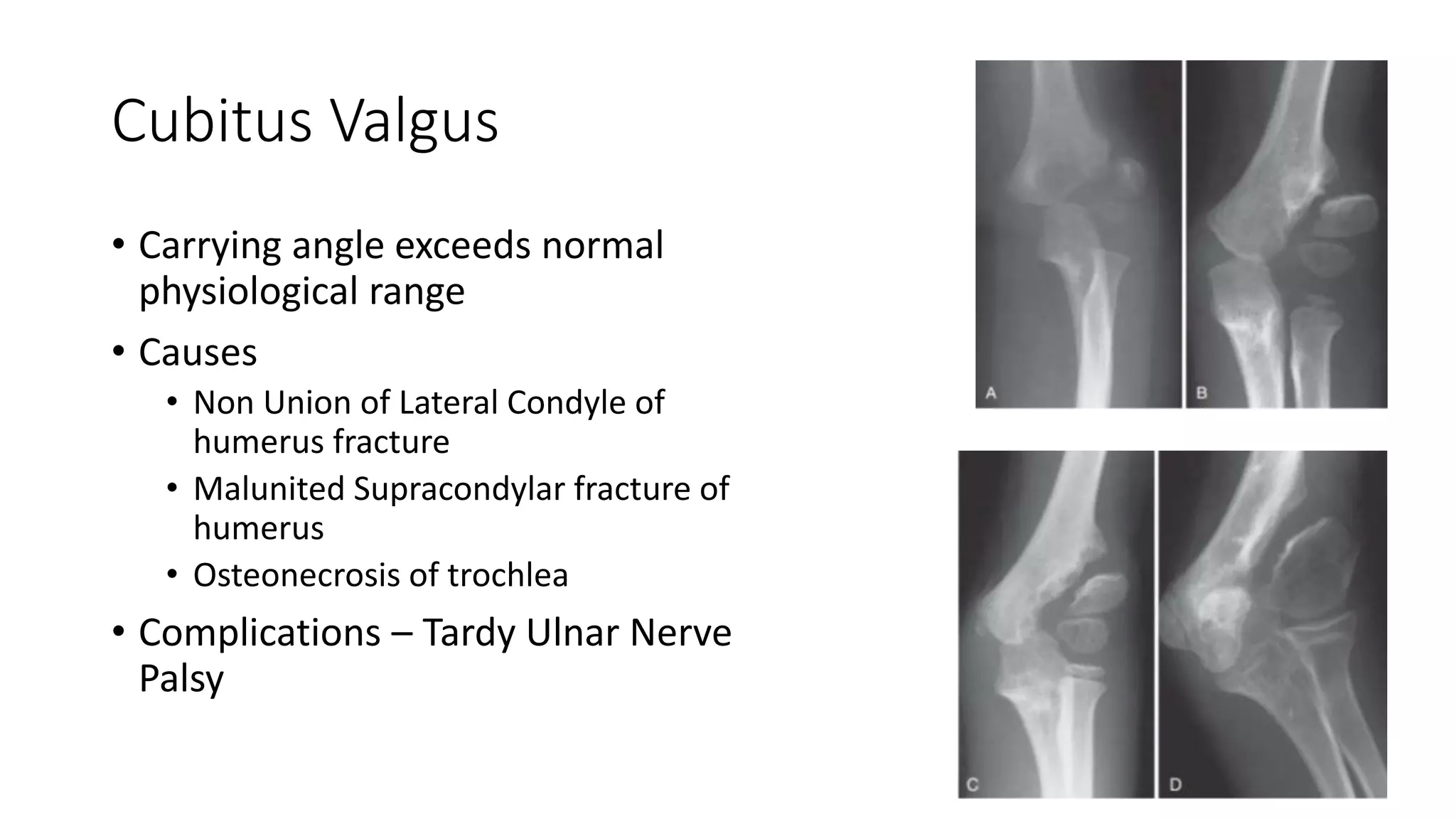Congenital and Acquired Deformities around Elbow.pptx
