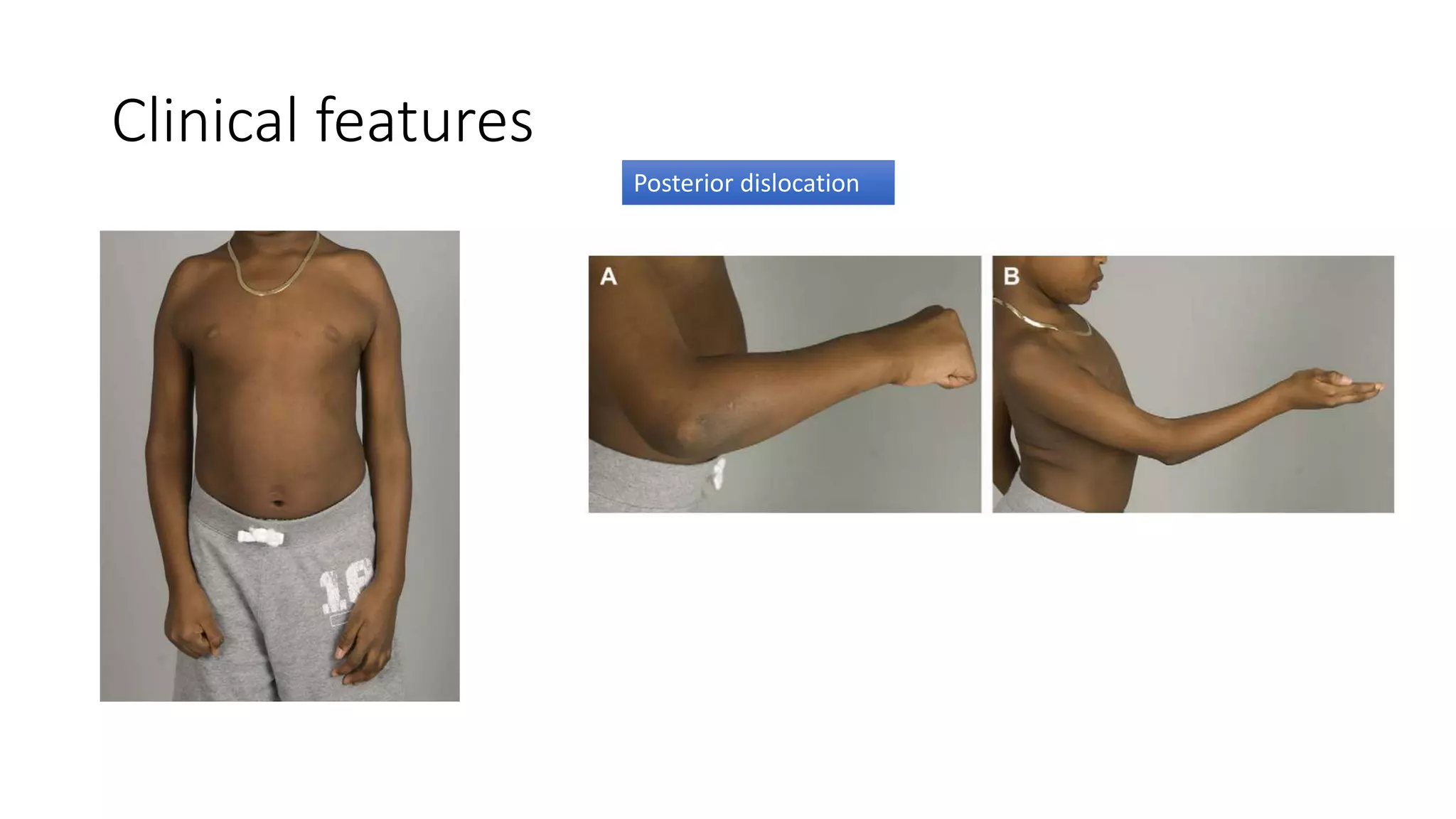 Congenital and Acquired Deformities around Elbow.pptx