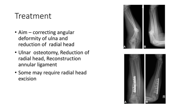 Congenital and Acquired Deformities around Elbow.pptx | Free Download