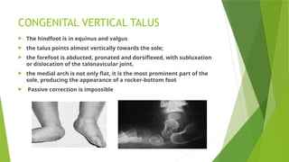 CONGENITAL DEFORMITIES OF FOOT-1.pptx and | PPTX