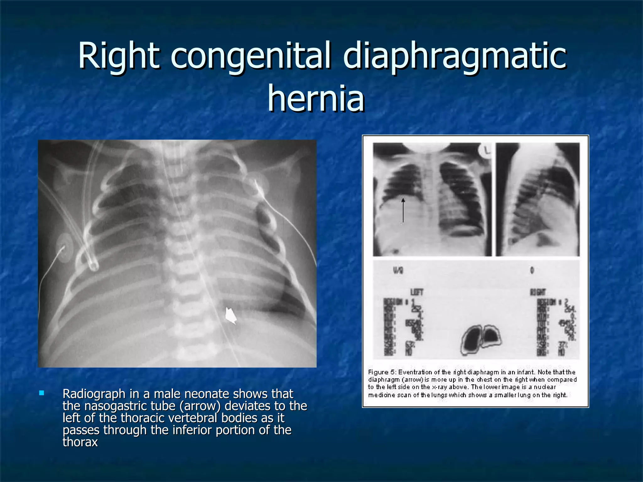 Congenital Diaphragmatic Hernia | PPT