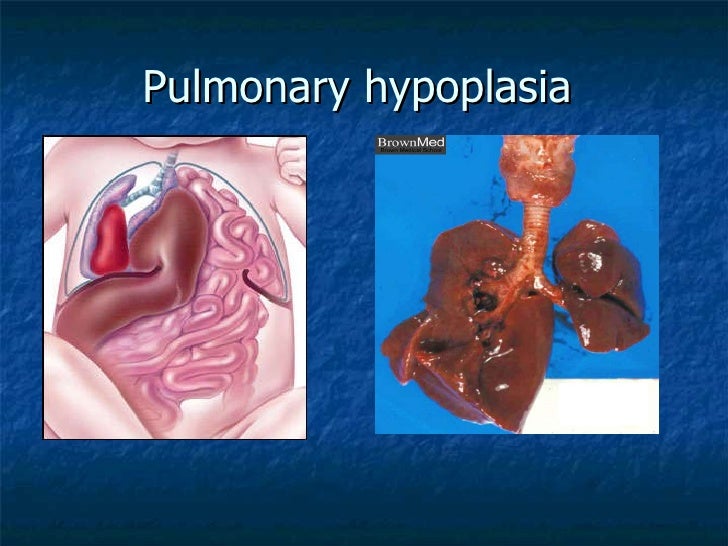 Congenital Diaphragmatic Hernia