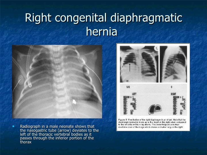 Congenital Diaphragmatic Hernia