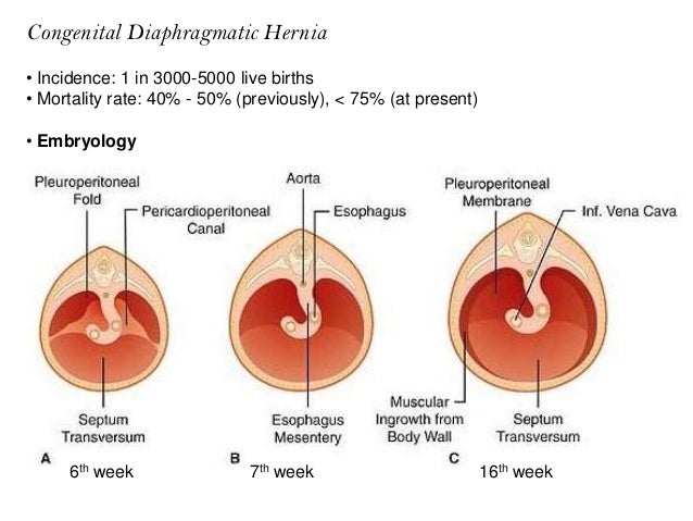 Congenital diaphragmatic hernia