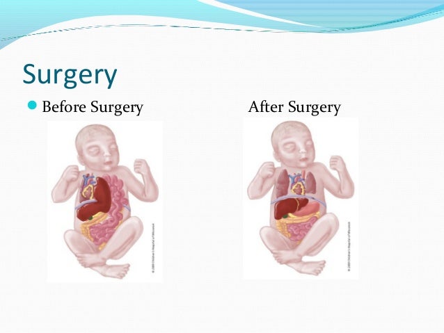 Congenital diaphragmatic hernia by Dr. Varsha Atul Shah