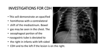 Congenital diaphragmatic hernia | PPTX