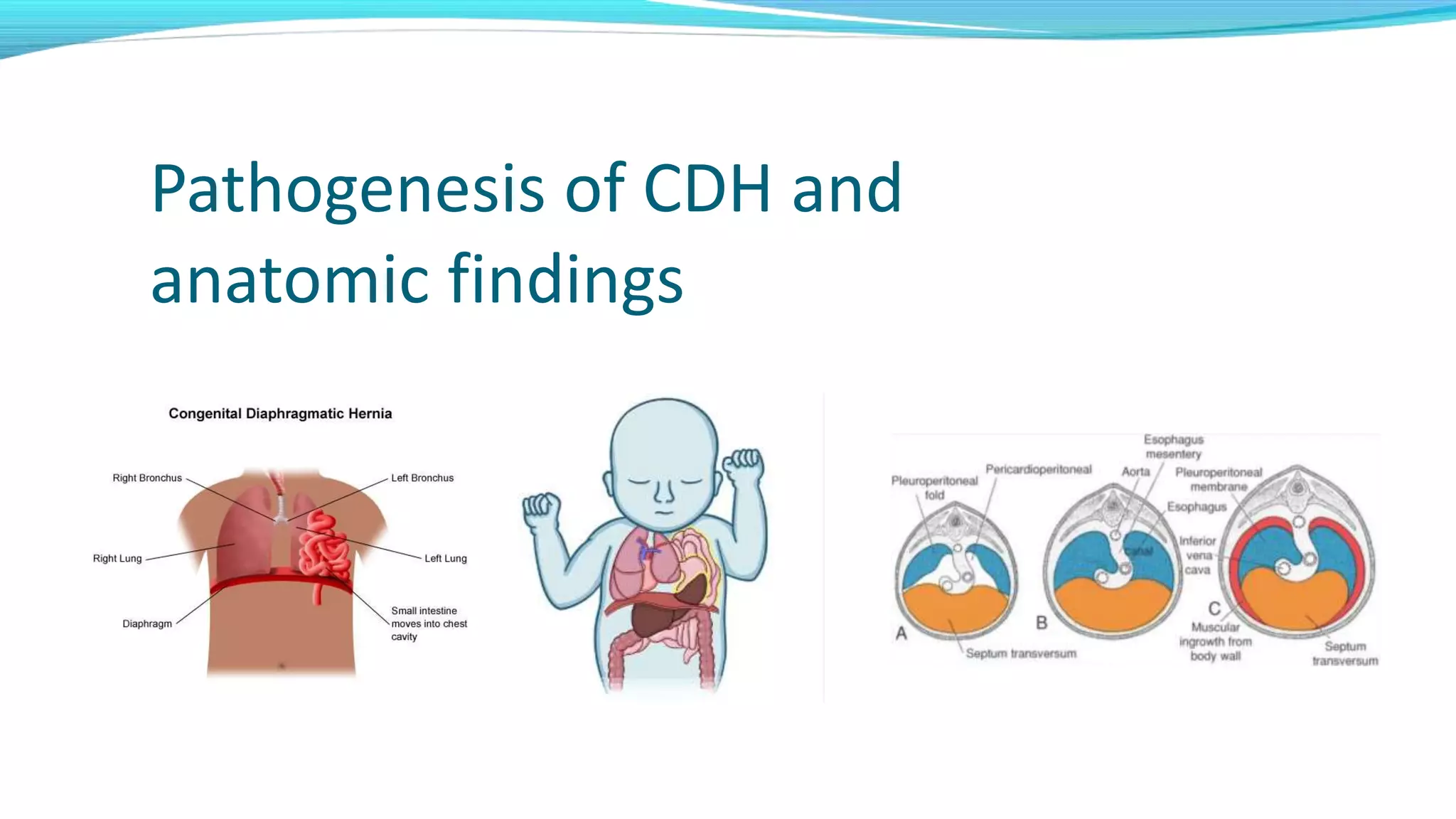 congenitaldiaphragmatichernia.pptx