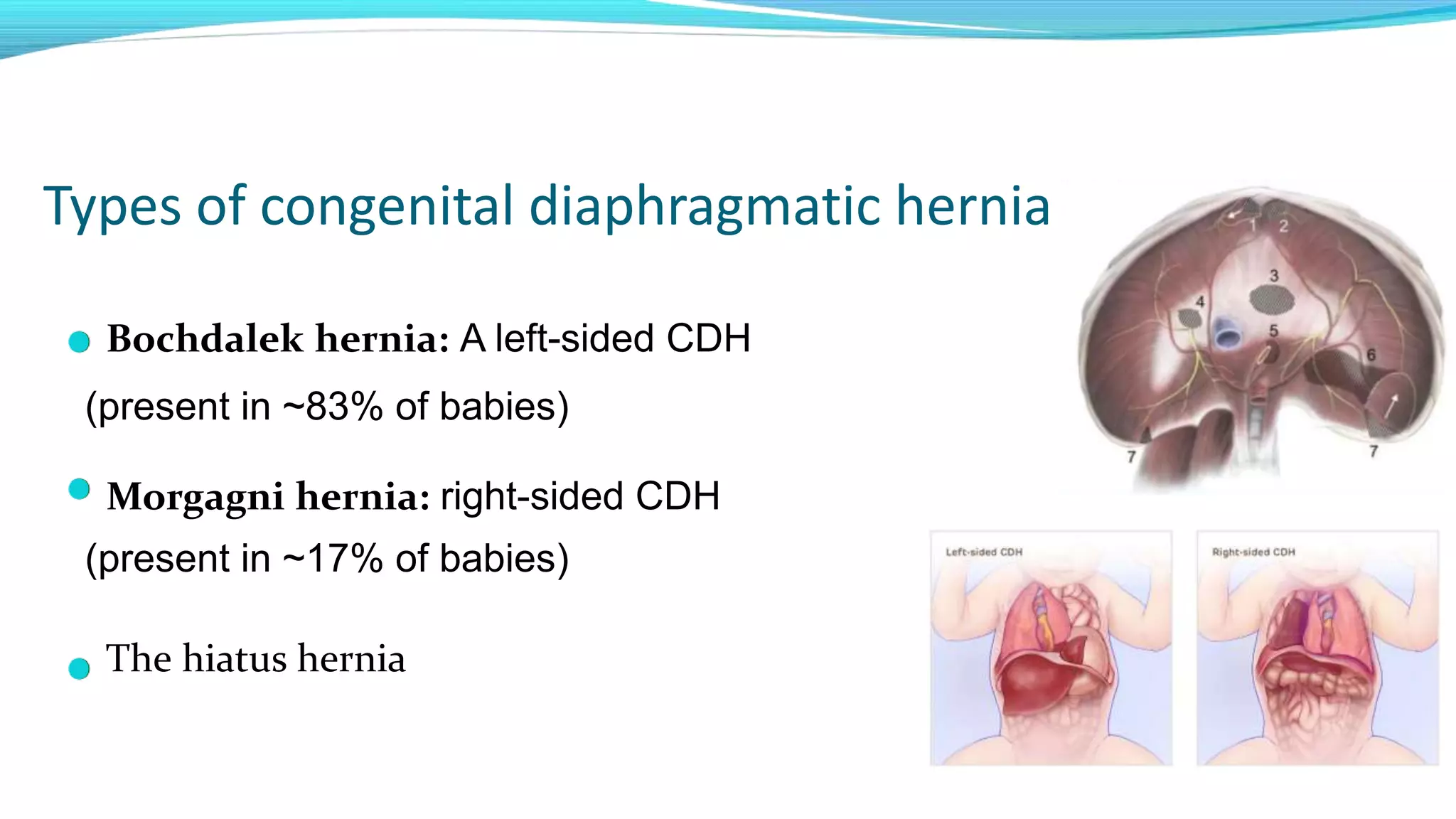congenitaldiaphragmatichernia.pptx