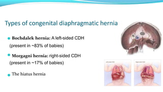 congenitaldiaphragmatichernia.pptx