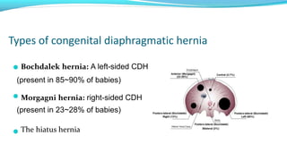 congenitaldiaphragmatichernia.pptx