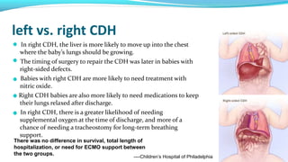 congenitaldiaphragmatichernia.pptx