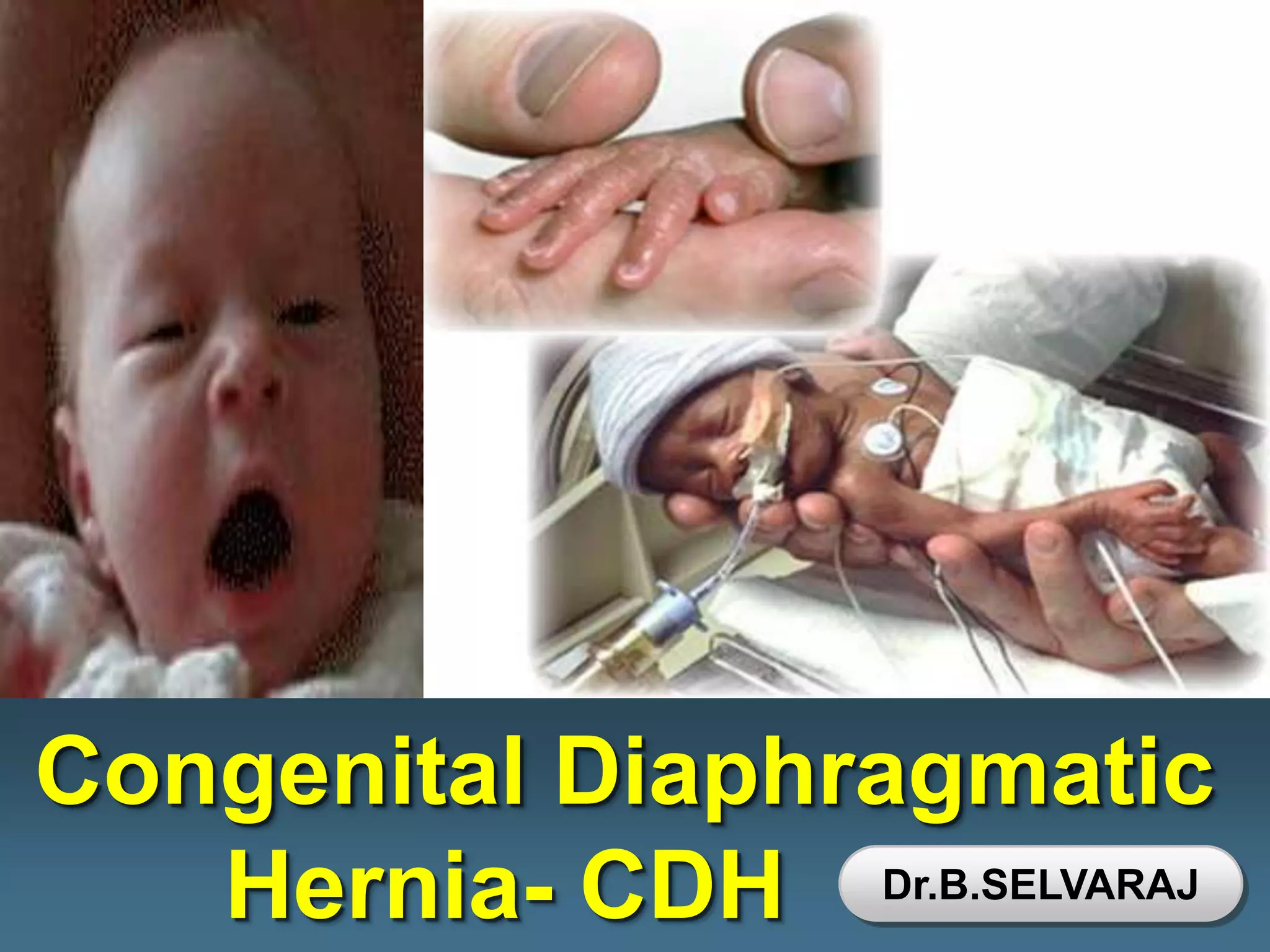 Congenital diaphragmatic hernia / Pediatric surgery | PPT