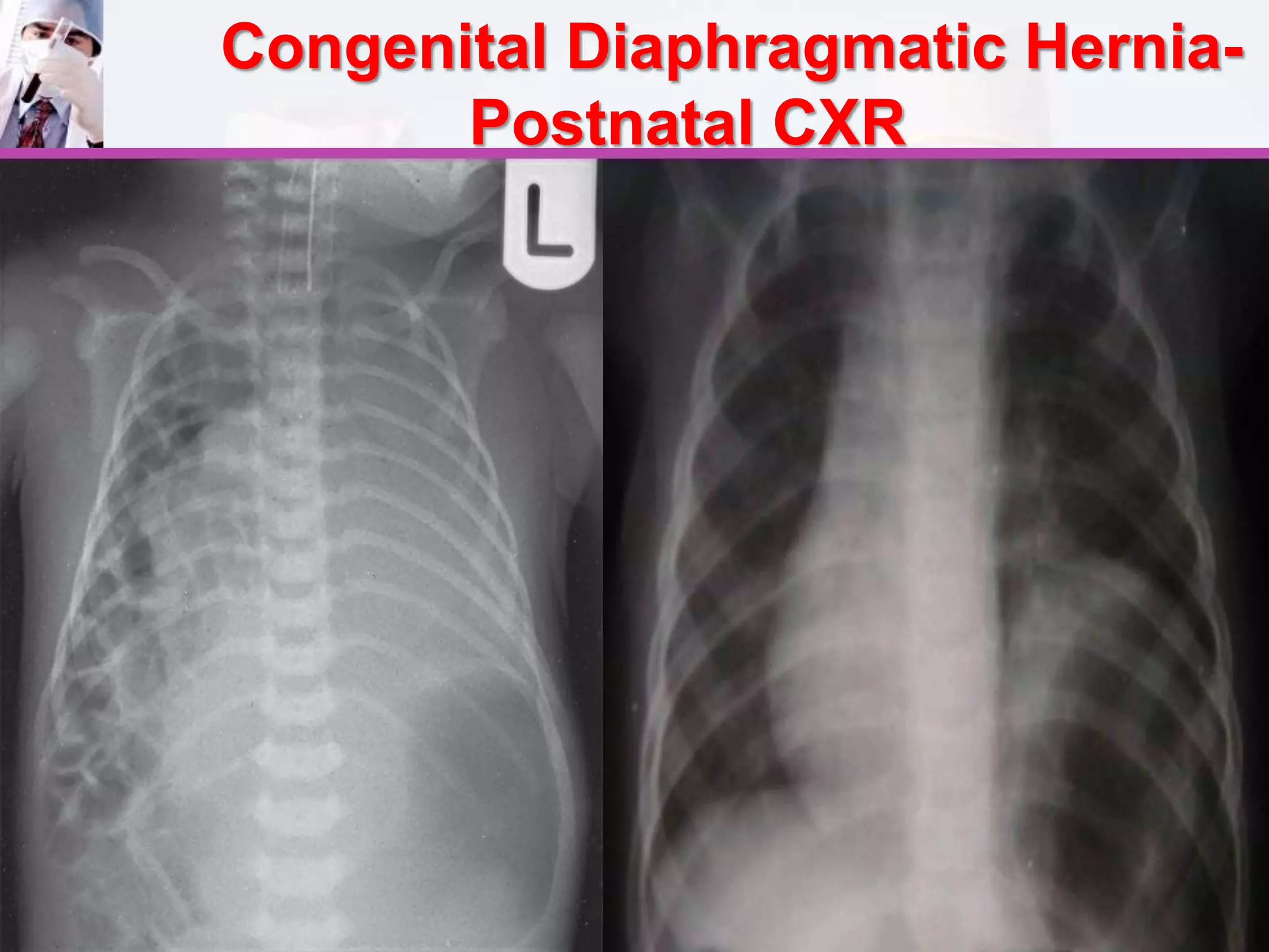 Congenital diaphragmatic hernia / Pediatric surgery | PPT