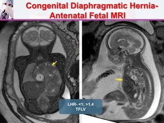 Congenital diaphragmatic hernia / Pediatric surgery | PPT