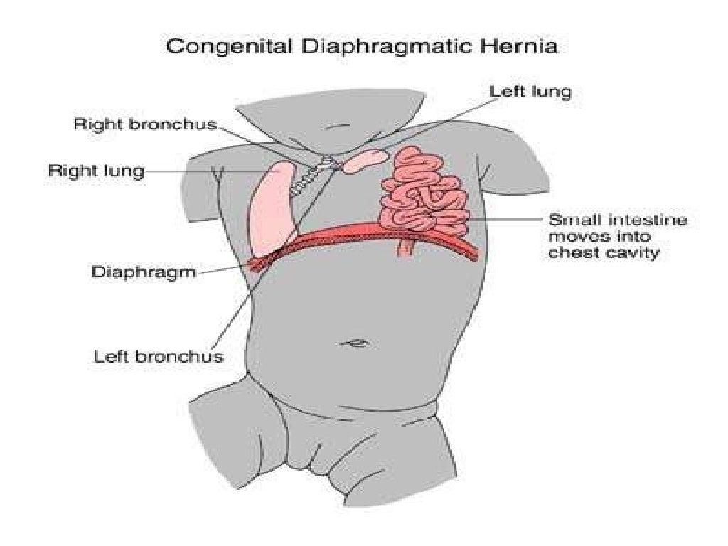 Congenital diaphragmatic hernia2