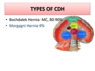 CONGENITAL DIAPHRAGMATIC HERNIA [Recovered].pptx | Pregnancy ...