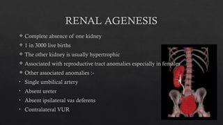 CONGENITAL DISEASES OF KIDNEY & URETER.pptx