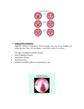 Diseases of larynx | DOCX