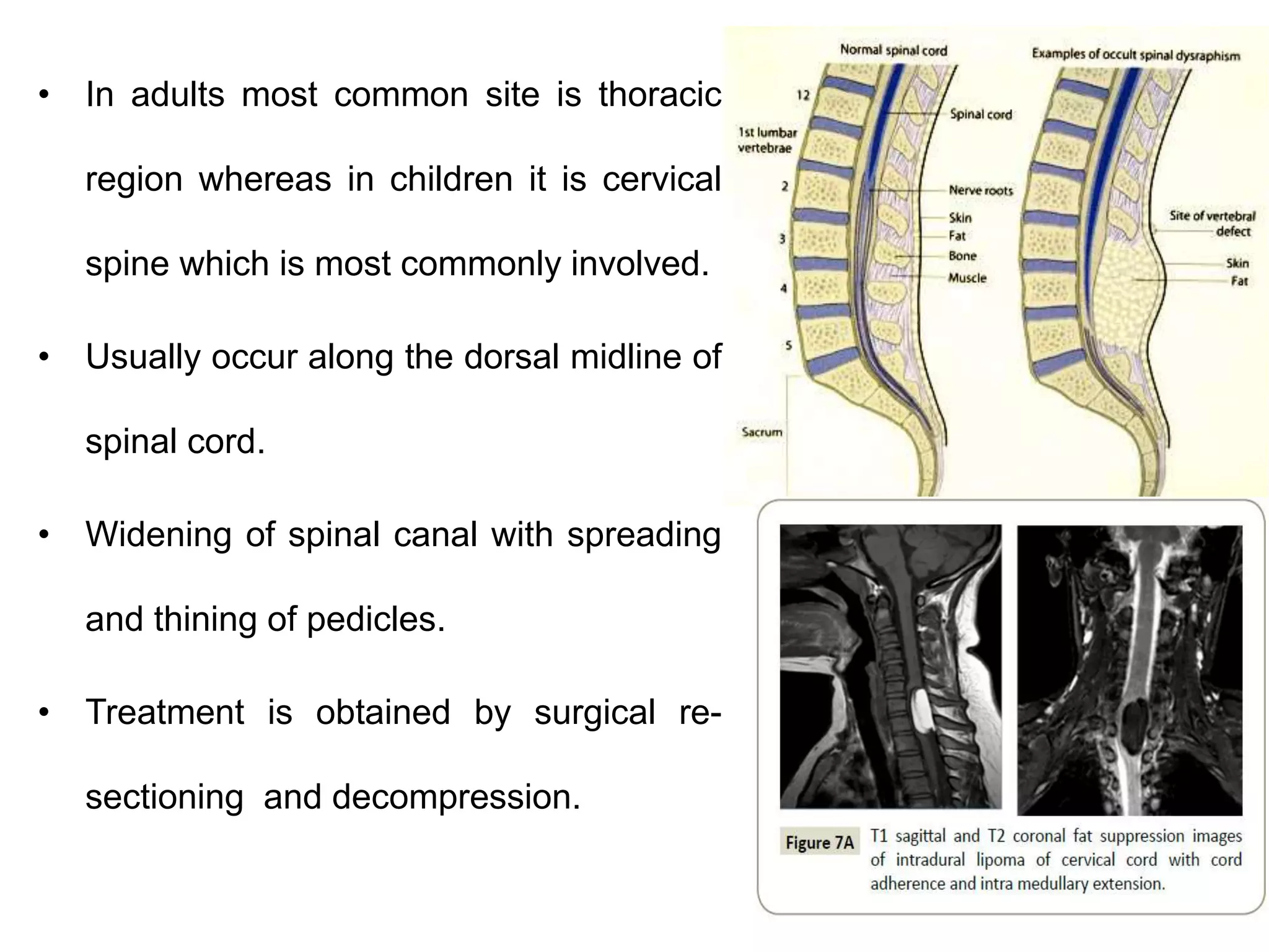 Congenital diseases causing Spinal Cord Compression | PPTX